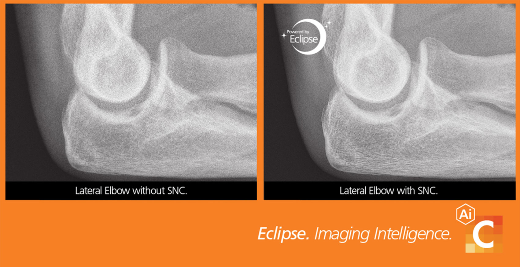 Carestream advances X-ray image quality with Smart Noise Cancellation ...