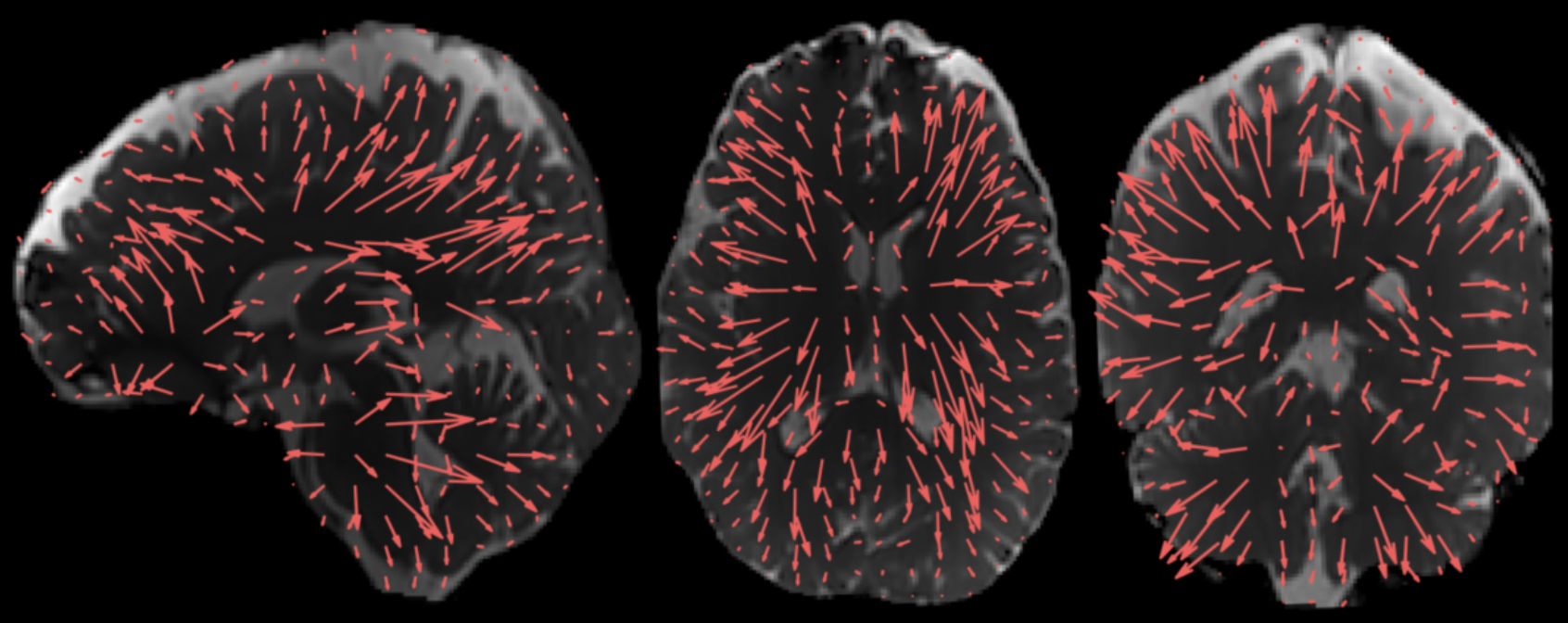 3D amplified MRI: Newly enhanced imaging technique captures brain ...