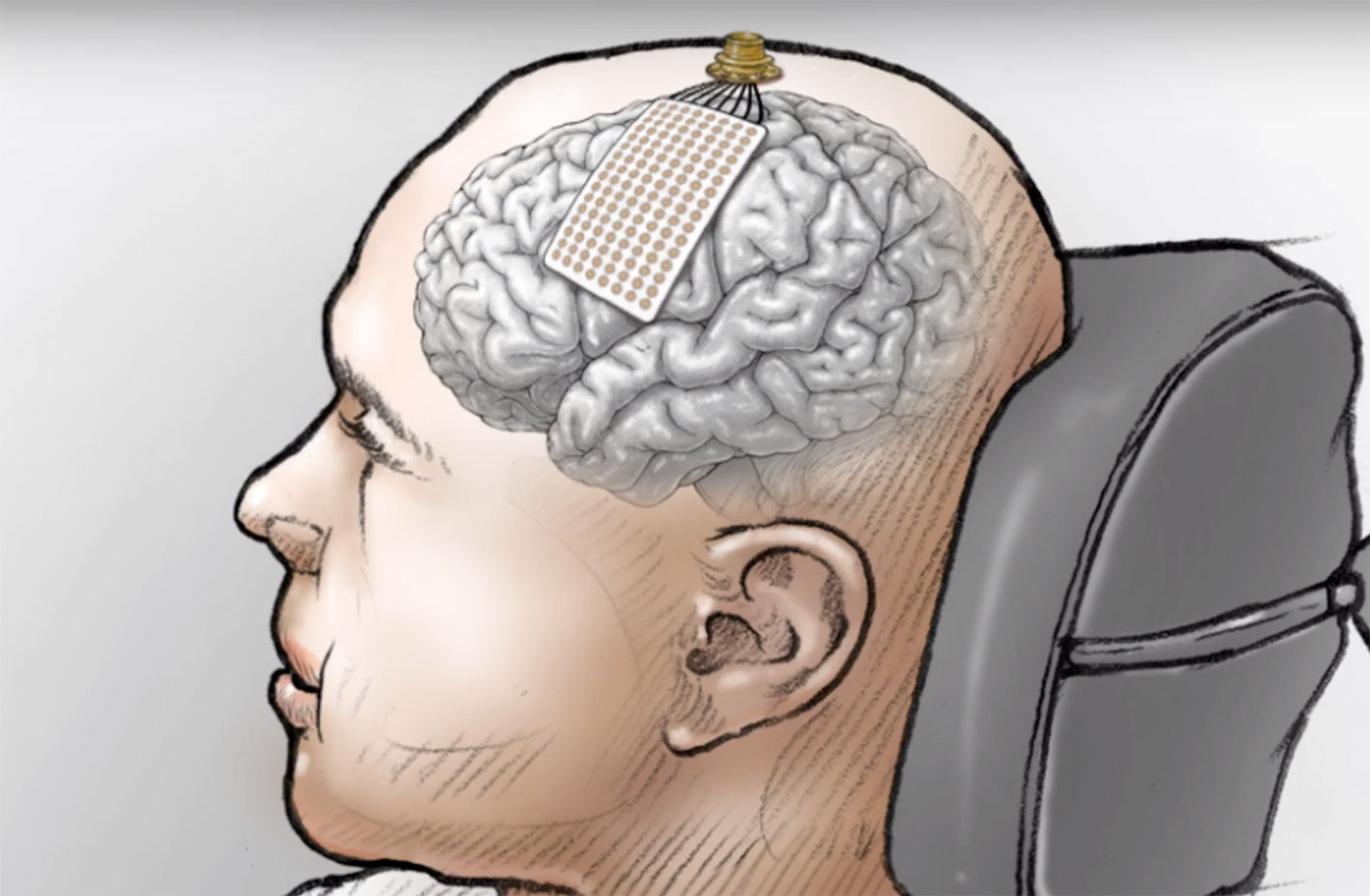 BREAKTHROUGH: researchers develop neuroprosthesis that enables ...