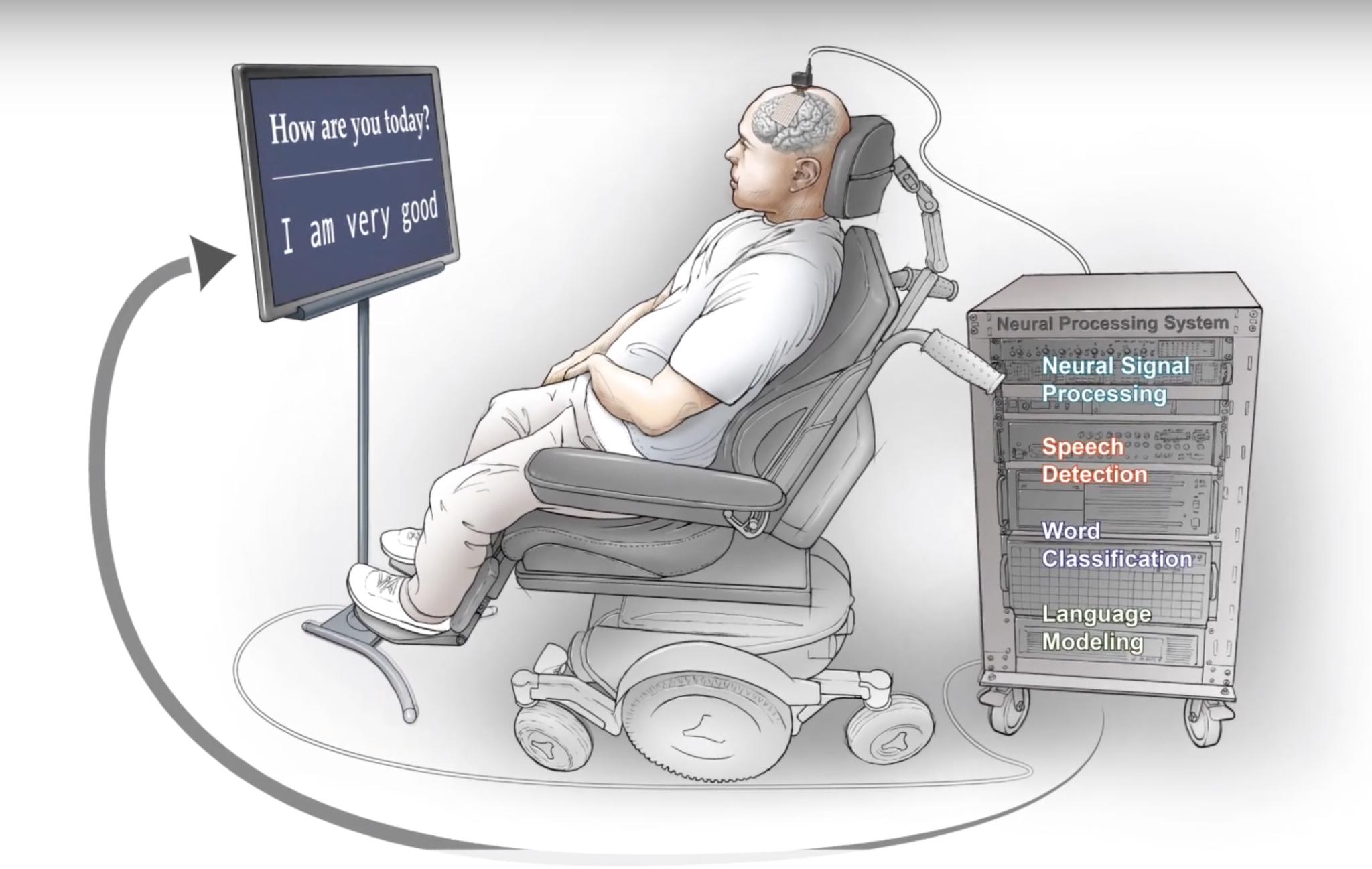 BREAKTHROUGH: researchers develop neuroprosthesis that enables ...