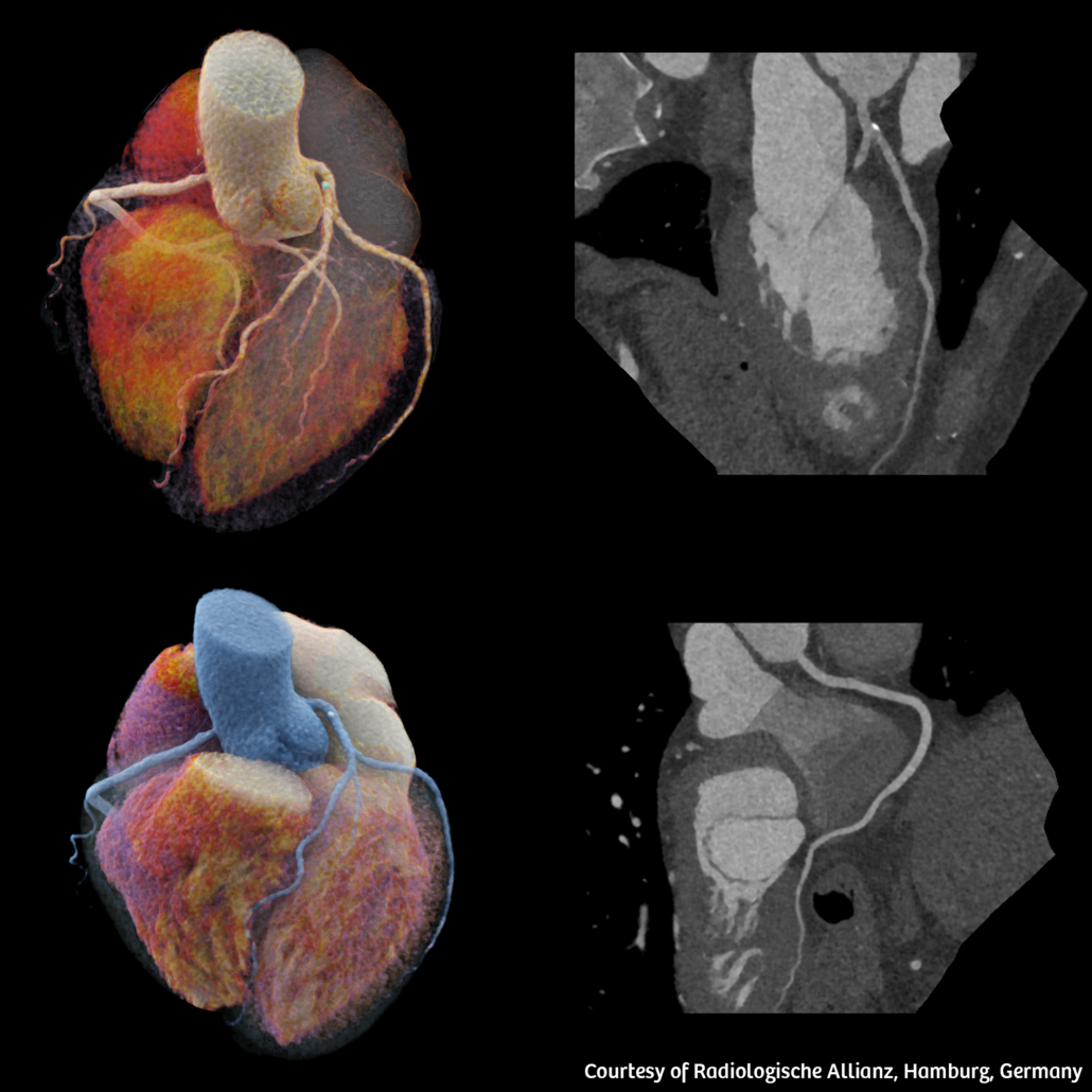 Siemens Healthineers broadens access to high-end Dual Source CT ...