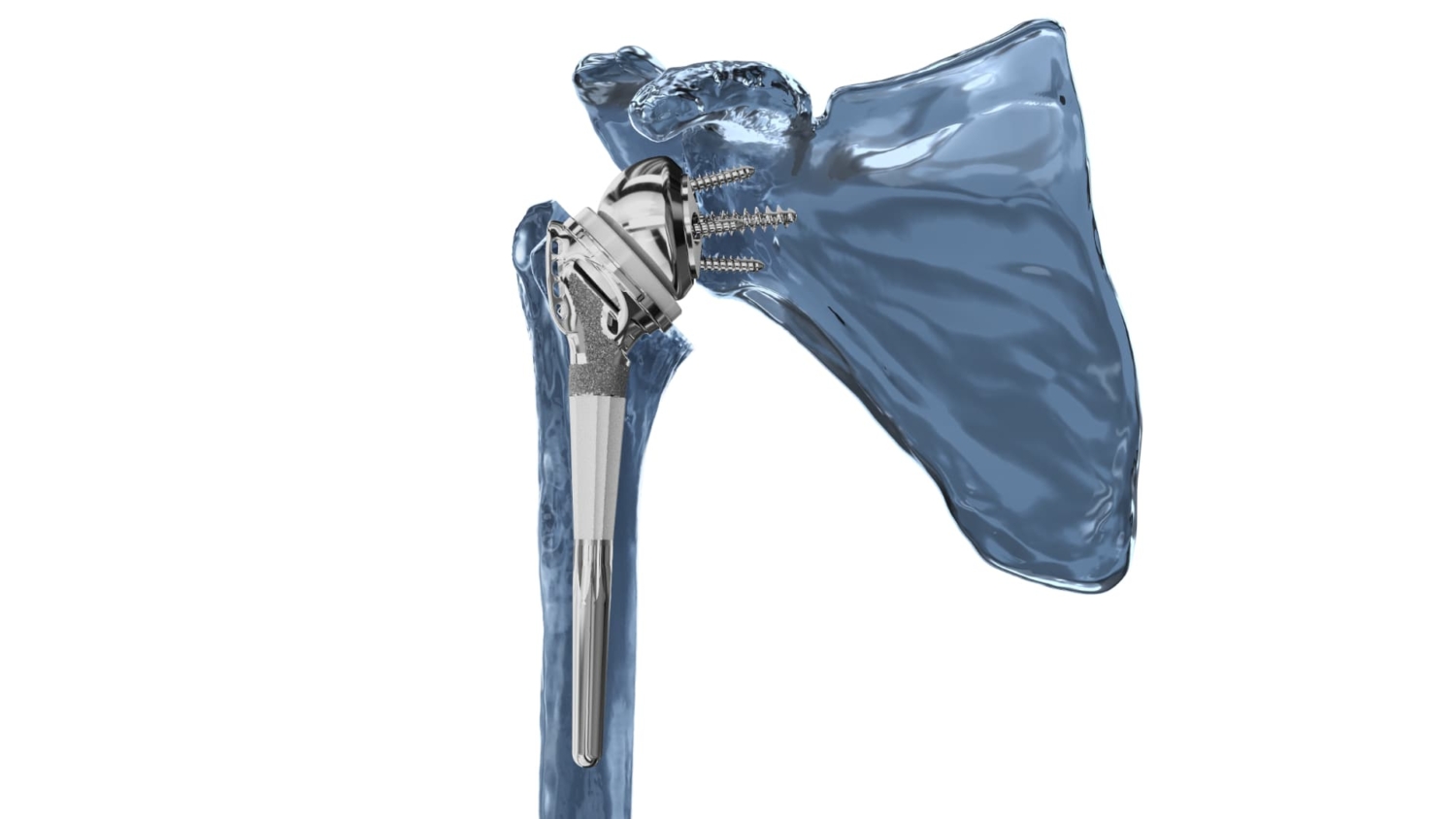 Catalyst OrthoScience receives FDA clearance for novel shoulder ...