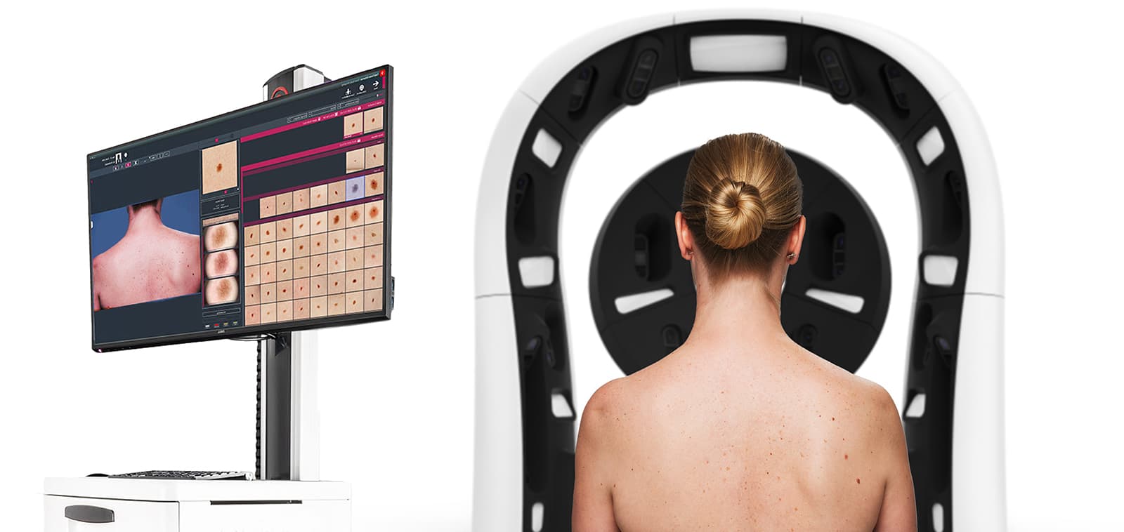 AI-enhanced full body scanner advances melanoma detection ...