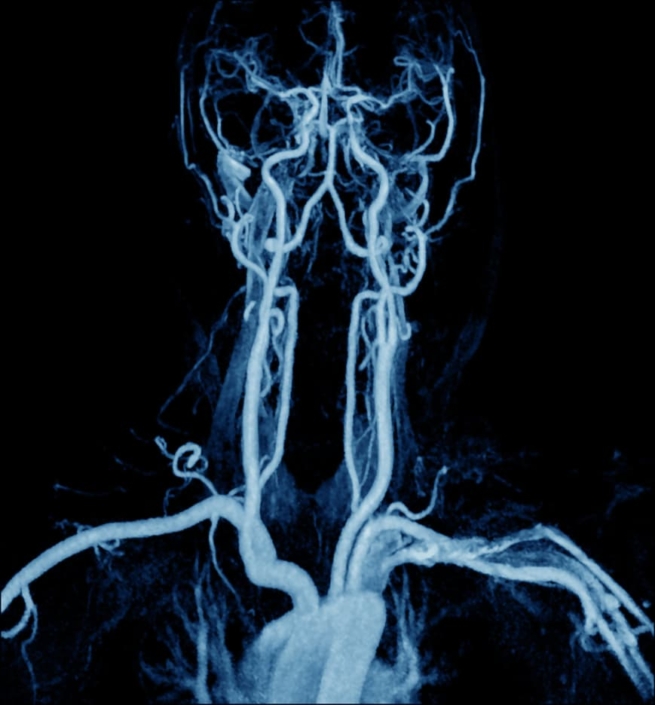 New study reveals TCAR outperforms TF-CAS for stroke prevention in ...